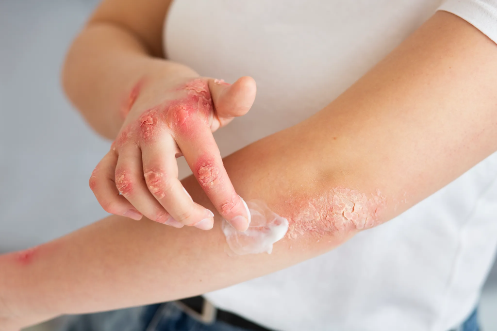 How to Avoid Eczema Flare-Ups: Effective Tips for Healthy Skin - eHallPass