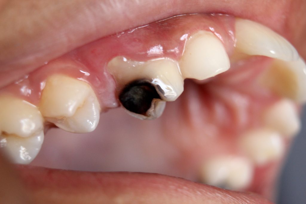 Sugar, Bacteria, and Beyond: What Causes Tooth Decay? - eHallPass
